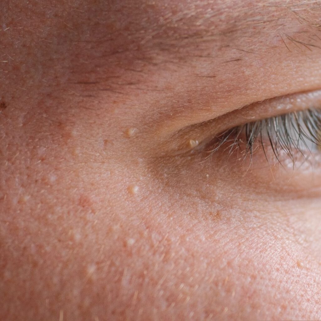 Points blancs autour des yeux : les grains de milium, que faire ? - Epicosm